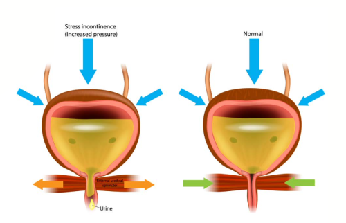 Losing Control | All You Need to Know About Stress Urinary incontinence ...