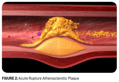 AngelMed Guardian Singapore: Heart Attack Alerts - Prime Magazine