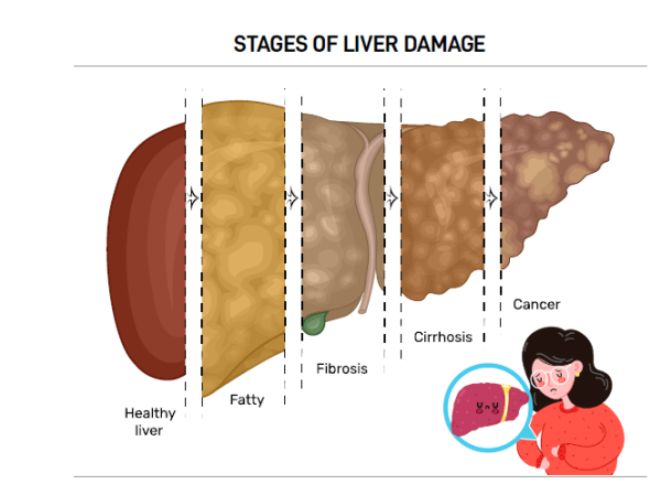 Her Filter : Common Liver Problems in Women’s Health by Dr Lu Wei ...
