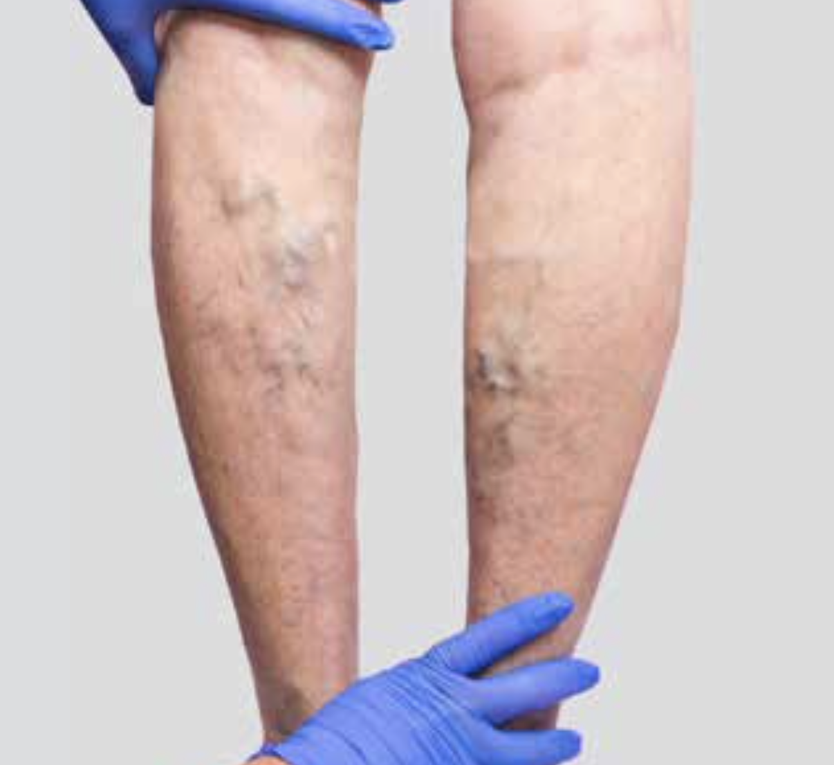 Deep Vein Thrombosis (DVT): Symptoms, Risks & Treatment - Prime Magazine