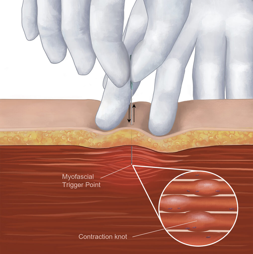 Dry Needling for Muscle Pain | Christopher Lo Physiotherapy - Prime ...