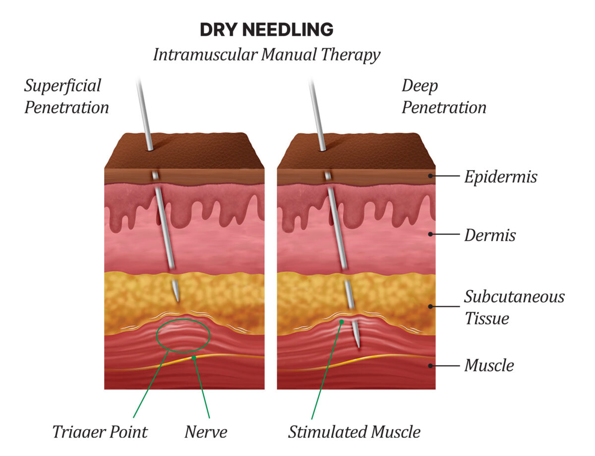 Dry Needling for Muscle Pain | Christopher Lo Physiotherapy - Prime ...